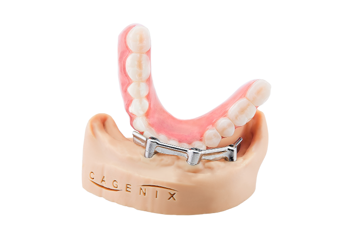 AccuFrame Overdenture - Cagenix Portal