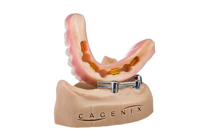AccuFrame Overdenture - Cagenix Portal