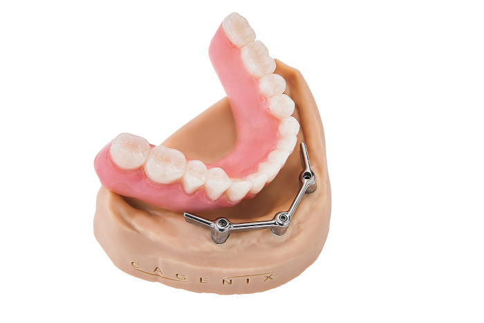 AccuFrame Overdenture - Cagenix Portal